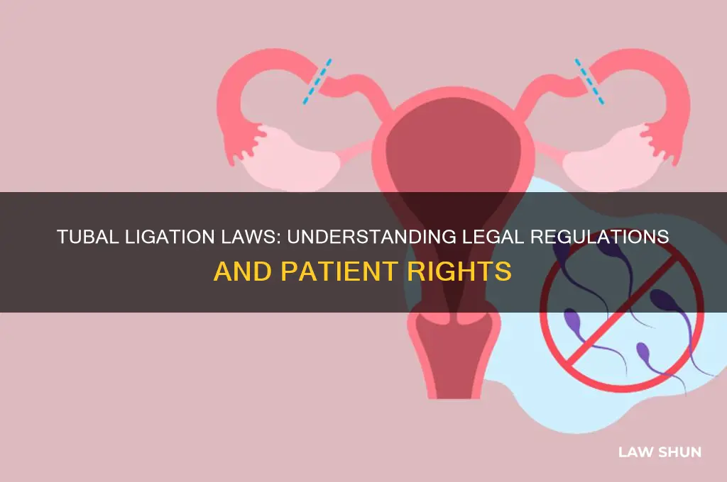 Tubal Ligation Laws: Understanding Legal Regulations And Patient Rights ...